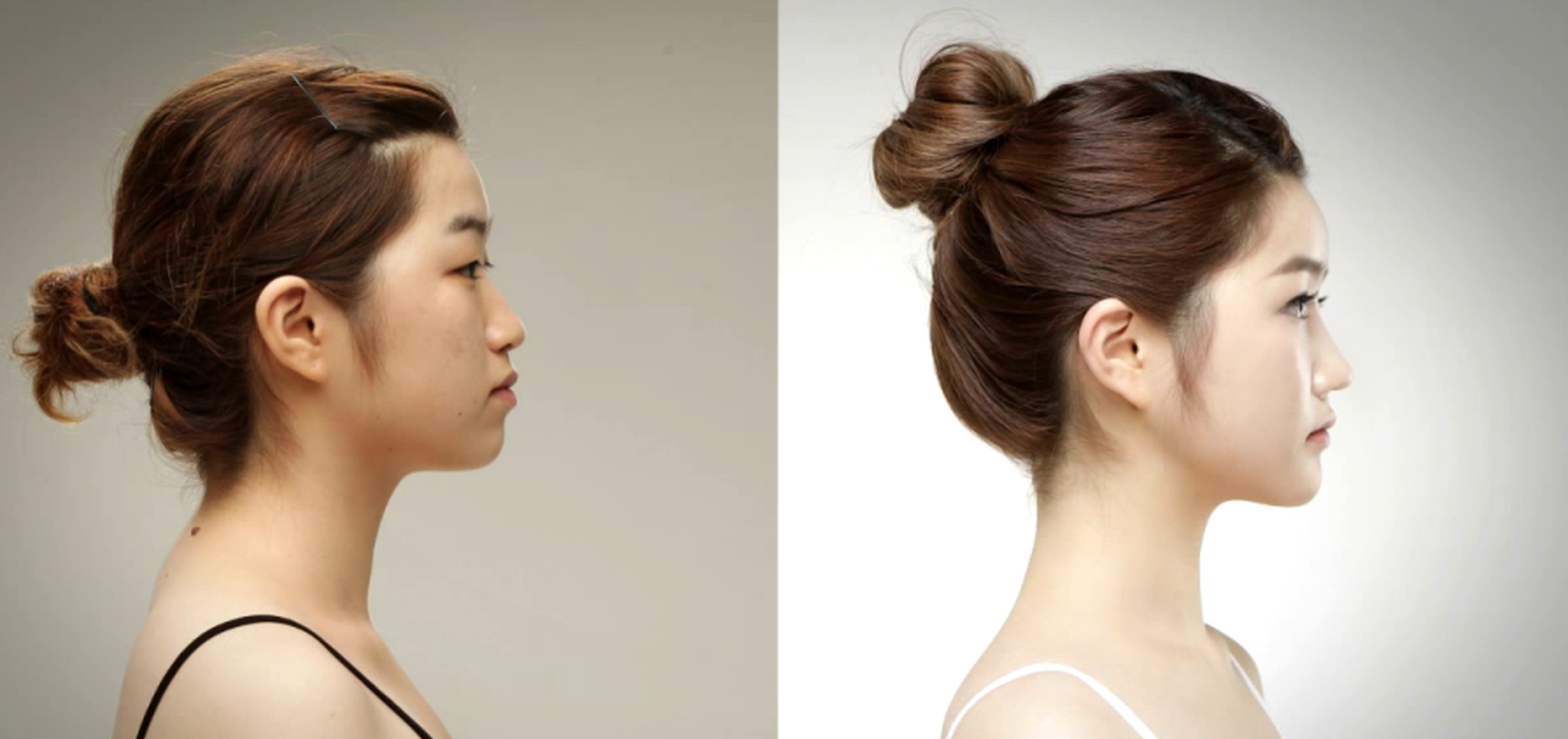 V-Line Surgery [The Line Plastic Surgery Clinic] picture